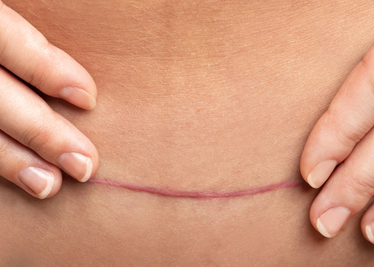 Understanding the Scar Healing Process